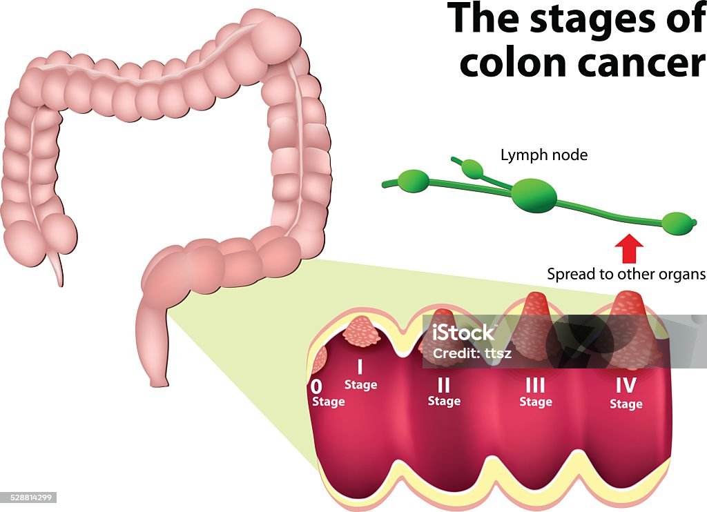The Stages Of Colorectal Cancer Stock Illustration Download Image Now Colorectal Cancer