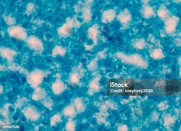 Micro 박테리아 결핵 On 가래 Afb 과학에 대한 스톡 사진 및 기타 이미지 과학 기생충 대장균 Istock