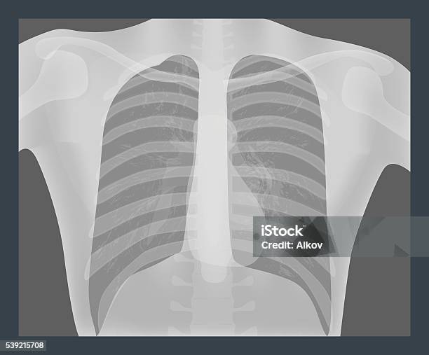 Ilustrasi Vektor Xray Dada Pencitraan Medis Paruparu Ilustrasi Stok