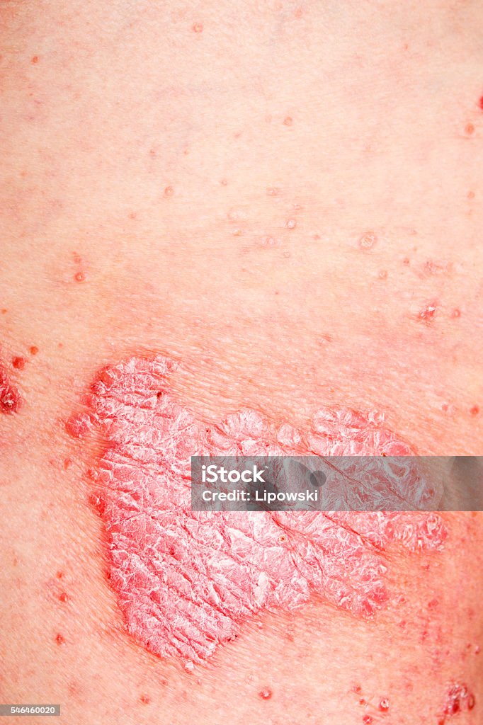 Psoriasis Vulgaris Is An Autoimmune Disease That Affects