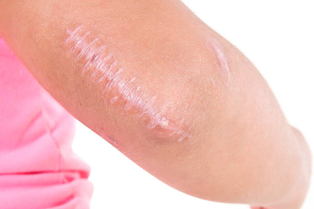 110+ Stitches Child Wound Laceration Stock Photos, Pictures & Royalty ... 110+ Stitches Child Wound Laceration Stock Photos, Pictures & Royalty ...