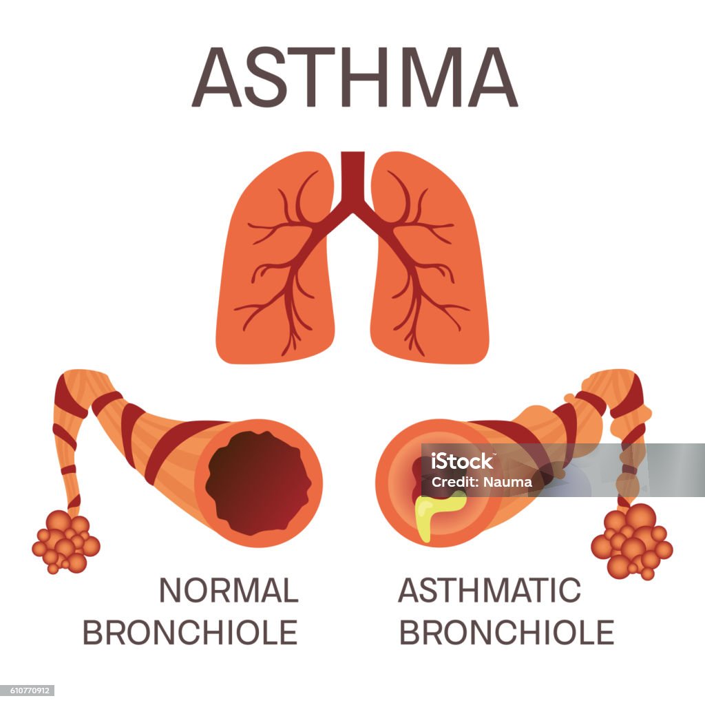 Bronkiole Normal Dan Asma Ilustrasi Stok Unduh Gambar Sekarang Anatomi Angin Asma