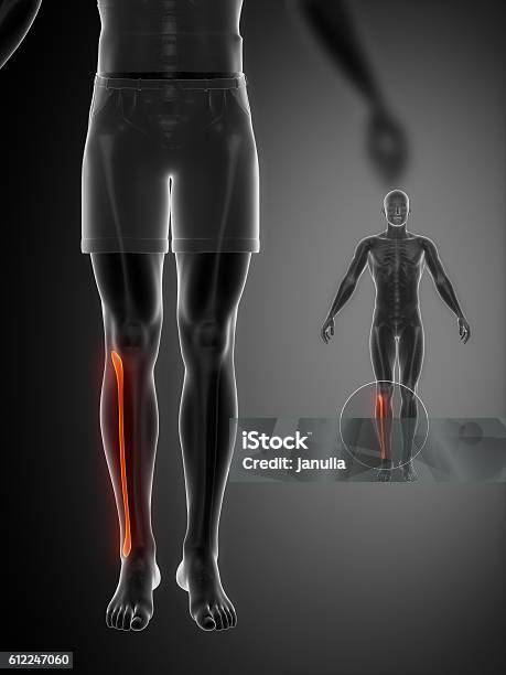 Fibula 블랙 X 선 뼈 스캔 골다공증에 대한 스톡 사진 및 기타 이미지 골다공증 골반 관절염 Istock