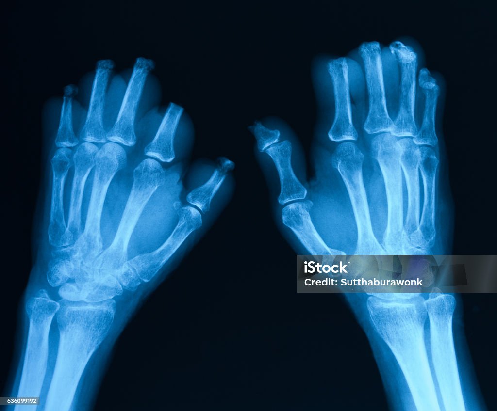 Imagen De Rayos X De Manos Bilaterales Vista Posteroanterior Foto de ... Imagen De Rayos X De Manos Bilaterales Vista Posteroanterior Foto de ...