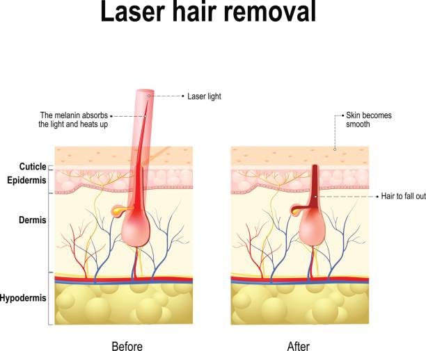 1 000 Hair Follicle Diagram Ilustraciones De Stock Gráficos