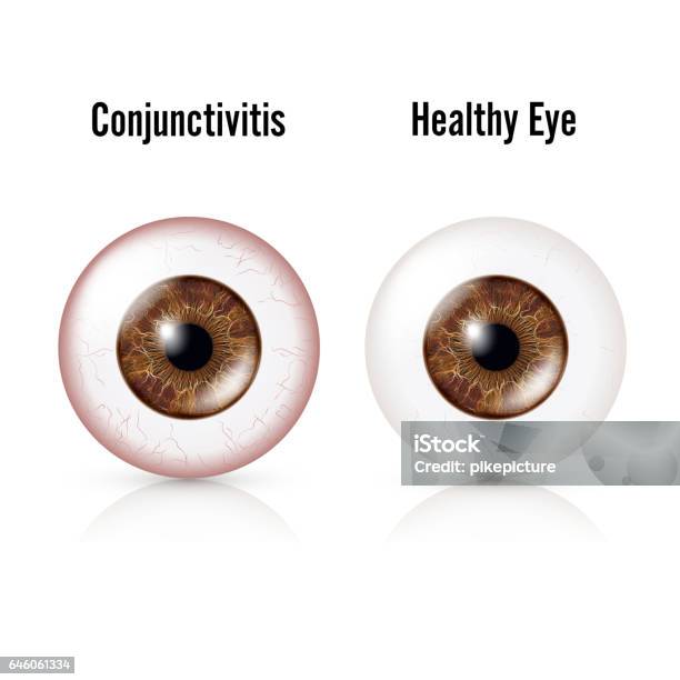 Ilustración De Conjuntivitis Ojo Rojo Ojo Sano Y Globo Ocular Con