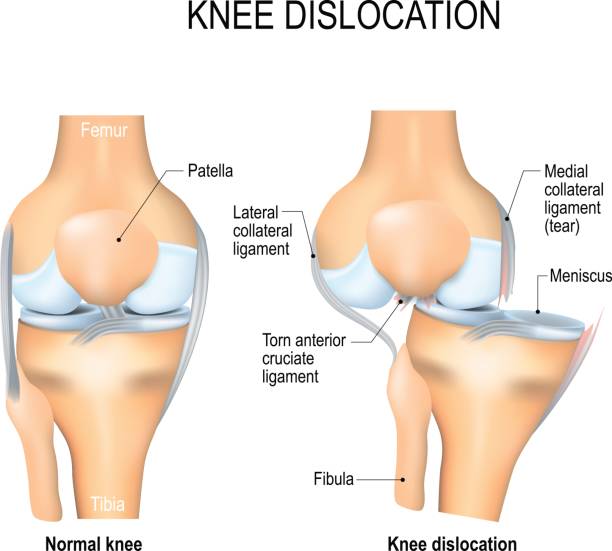 Medial Meniscus Tear