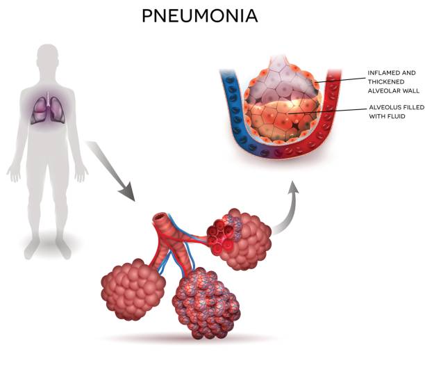 120+ Alveoli Damage Stock Illustrations, Royalty-Free Vector Graphics ... 120+ Alveoli Damage Stock Illustrations, Royalty-Free Vector Graphics ...