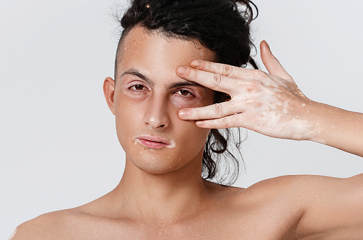 Vitiligo 남자 초상화입니다 스튜디오 촬영 건강관리와 의술에 대한 스톡 사진 및 기타 이미지 건강관리와 의술 건강한