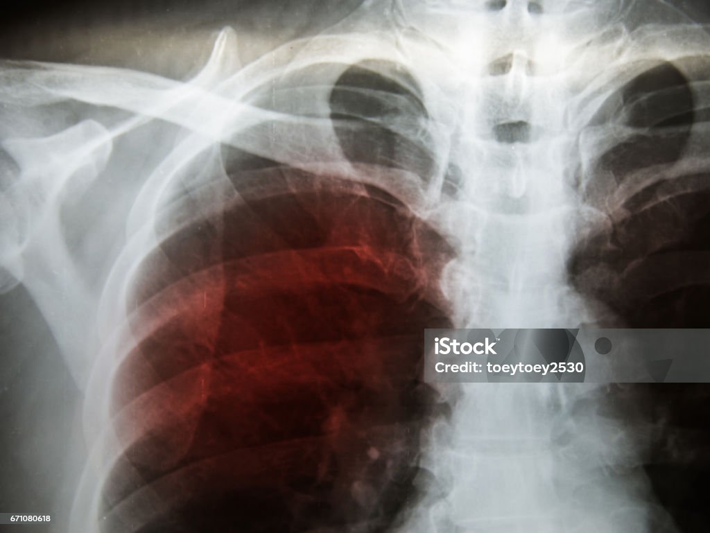 Pulmonary Tuberculosis Chest Xray Show Alveolar Infiltration At Both Lung Due To Mycobacterium