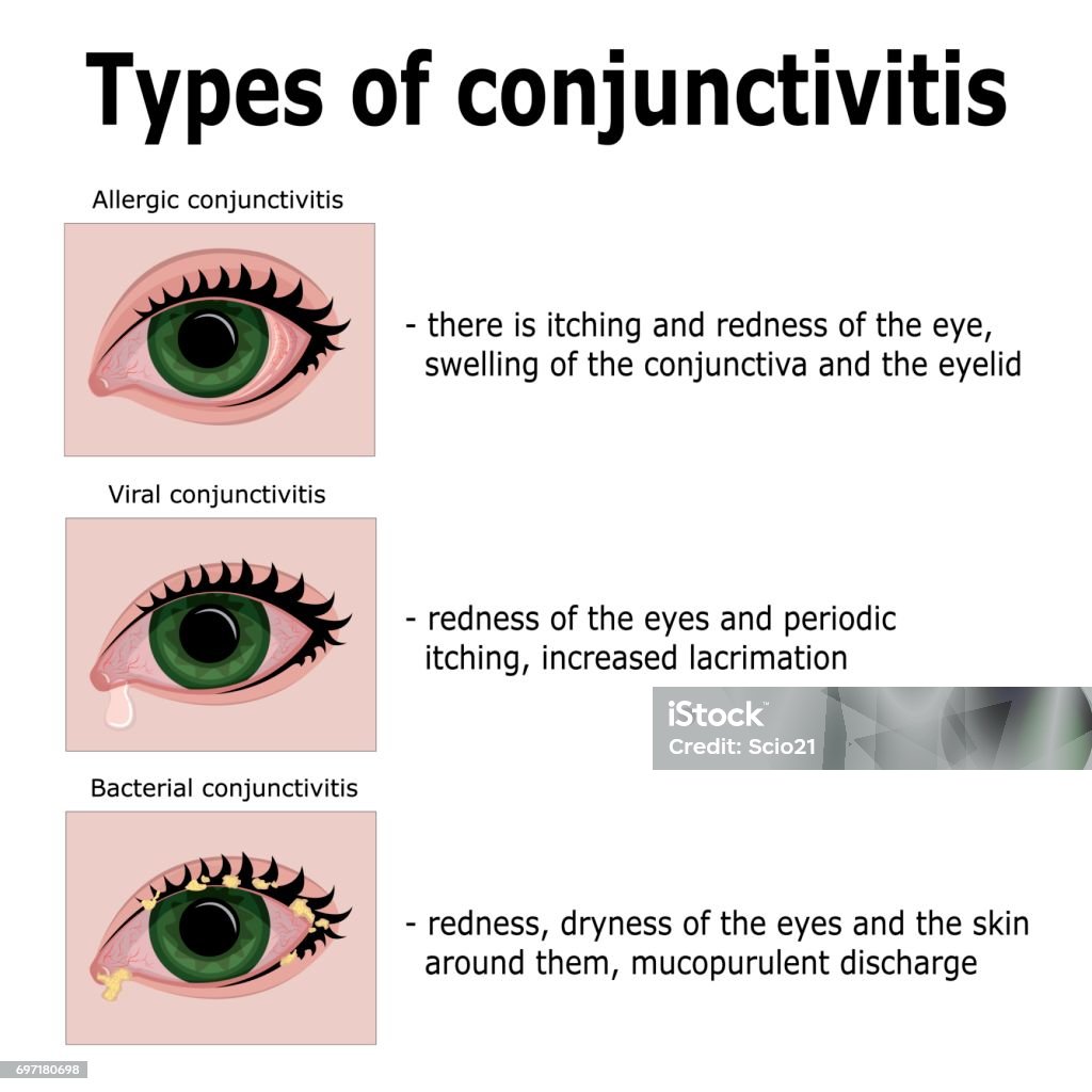Ilustración De Tipos De Conjuntivitis Y Más Vectores Libres De Derechos