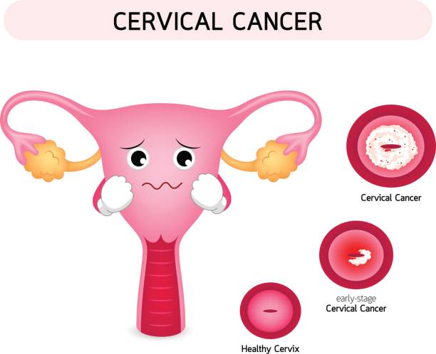 220 Cervical Cancer Symptoms Stock Illustrations Royalty Free Vector