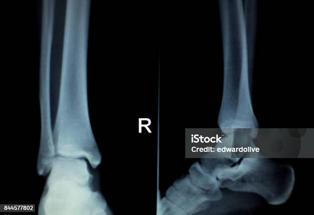 Xray 발 뒤꿈치 발목 테스트 검사 결과 부상 수술 후 정형 외과 티타늄 금속 임 플 란 트 나사를 보여주는 X 레이에 대한