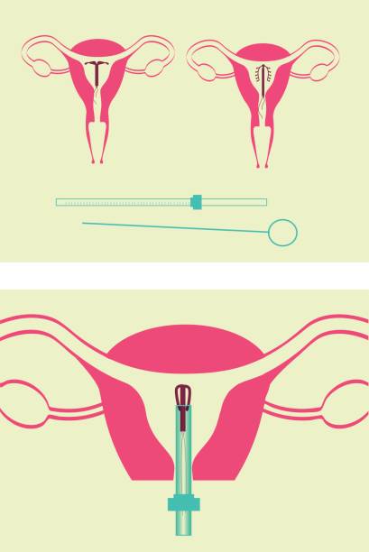 470 Iud Stock Illustrations Royalty Free Vector Graphics And Clip Art