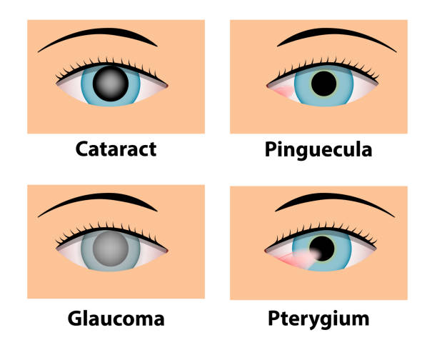 10+ Pterygium Stock Illustrations, Royalty-Free Vector Graphics & Clip ... 10+ Pterygium Stock Illustrations, Royalty-Free Vector Graphics & Clip ...