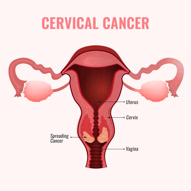 70 Cervical Dysplasia Stock Illustrations Royalty Free Vector
