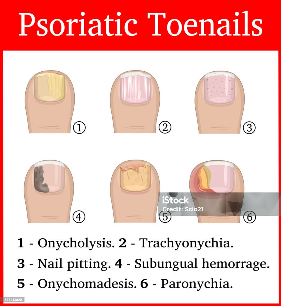 Onycholysis Psoriasis