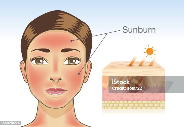Skin Layer Of Woman Which Appear Redness From Sunburn Stock