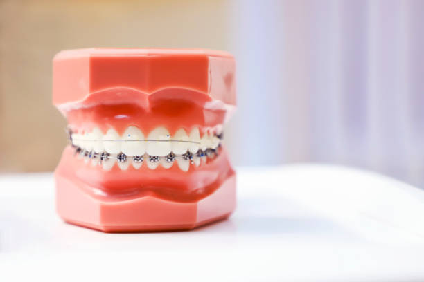 Free Stock Photo of Plastic Model of Teeth With Braces | Download Free ...