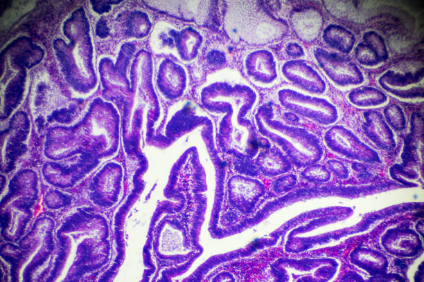 Carcinoma of the large intestine (well diff. tubular adenocarcinoma ...