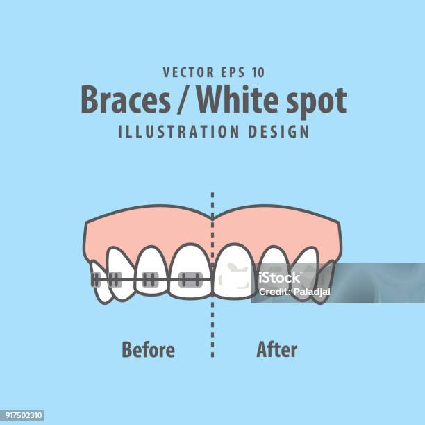 Kawat Gigiwhite Spot Ilustrasi Vektor Pada Latar Belakang Biru Konsep