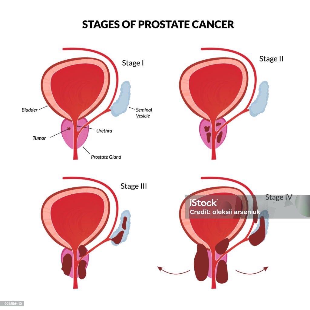 Four Stages Of Prostate Cancer Stock Illustration Download Image Now