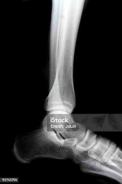 근접 Xray 발목 X 레이에 대한 스톡 사진 및 기타 이미지 X 레이 건강 진단 건강관리와 의술 Istock