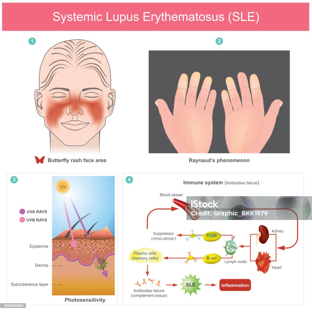Systemic Lupus Erythematosus Knowledge Amboss 45 Off