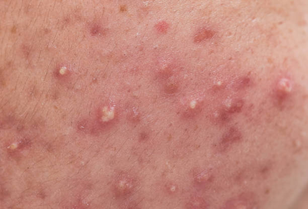 Acne Cyst Forehead
