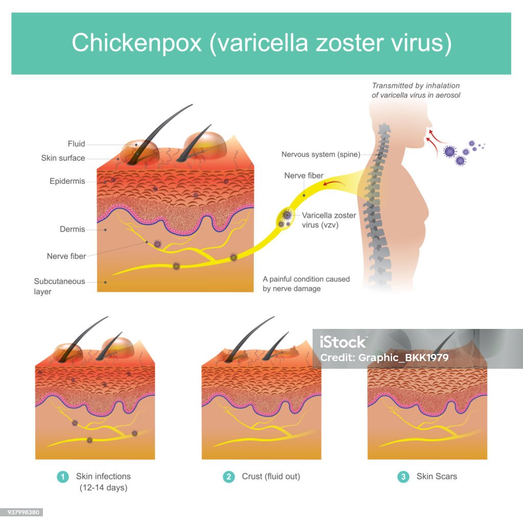 Chickenpox Varicella Zoster Virus Stock Illustration Download Image
