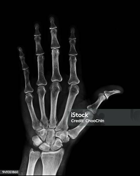 Gambar Sinarx Dari Tangan Normal Latar Belakang Medis Xray Foto Stok