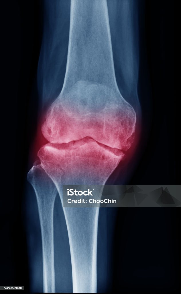Osteoartritis De Rodilla Osteofitos Esclerosis Subcondral Foto de stock ... Osteoartritis De Rodilla Osteofitos Esclerosis Subcondral Foto de stock ...