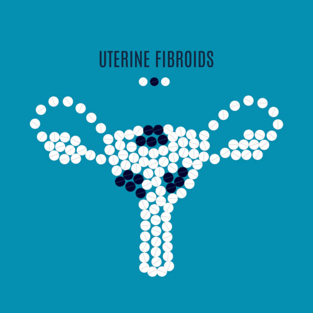 350 Uterine Fibroid Stock Illustrations Royalty Free Vector Graphics