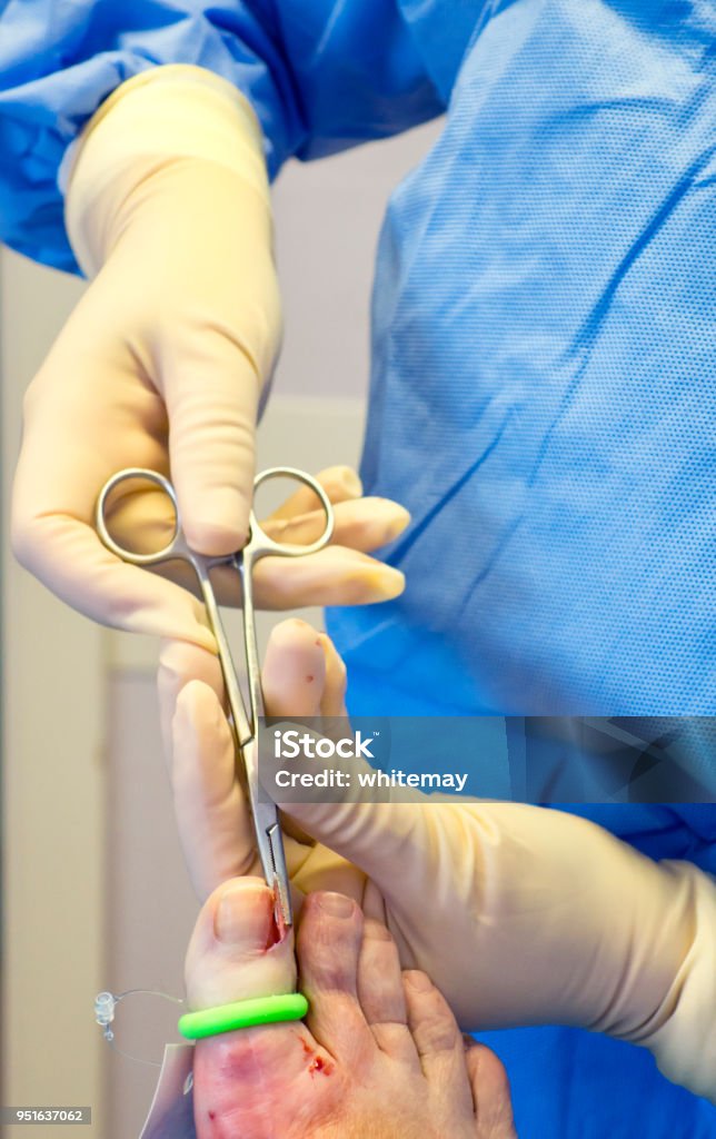 Removing Part Of A Toenail During Ingrown Toenail Surgery Stock Photo ... Removing Part Of A Toenail During Ingrown Toenail Surgery Stock Photo ...