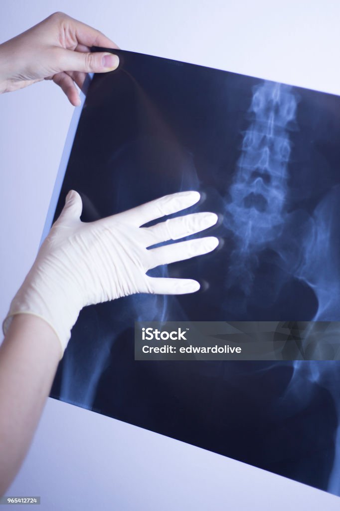 Rumah Sakit Medis Xray Rendah Punggung Nyeri Tulang Belakang Dan ... Rumah Sakit Medis Xray Rendah Punggung Nyeri Tulang Belakang Dan ...