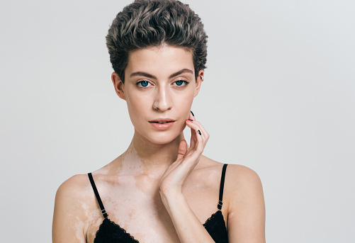 Vitiligo 여자 아름다움 초상화입니다 스튜디오 촬영 회색 배경입니다 건강관리와 의술에 대한 스톡 사진 및 기타 이미지