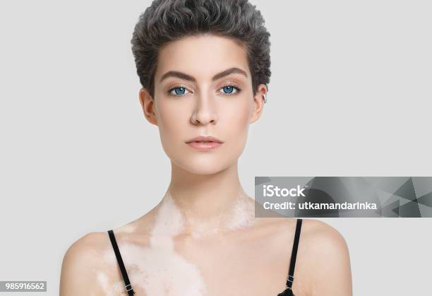 Vitiligo 여자 아름다움 초상화입니다 스튜디오 촬영 회색 배경입니다 건강관리와 의술에 대한 스톡 사진 및 기타 이미지