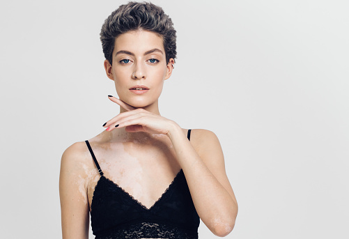Vitiligo 여자 아름다움 초상화입니다 스튜디오 촬영 회색 배경입니다 건강관리와 의술에 대한 스톡 사진 및 기타 이미지