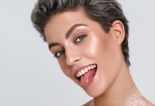 Vitiligo 여자 아름다움 초상화입니다 스튜디오 촬영 회색 배경입니다 건강관리와 의술에 대한 스톡 사진 및 기타 이미지