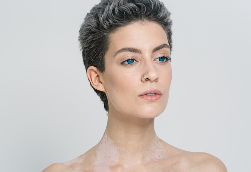 Vitiligo 여자 아름다움 초상화입니다 스튜디오 촬영 회색 배경입니다 건강관리와 의술에 대한 스톡 사진 및 기타 이미지