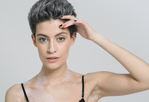 Vitiligo 여자 아름다움 초상화입니다 스튜디오 촬영 회색 배경입니다 젊은 여자에 대한 스톡 사진 및 기타 이미지 젊은