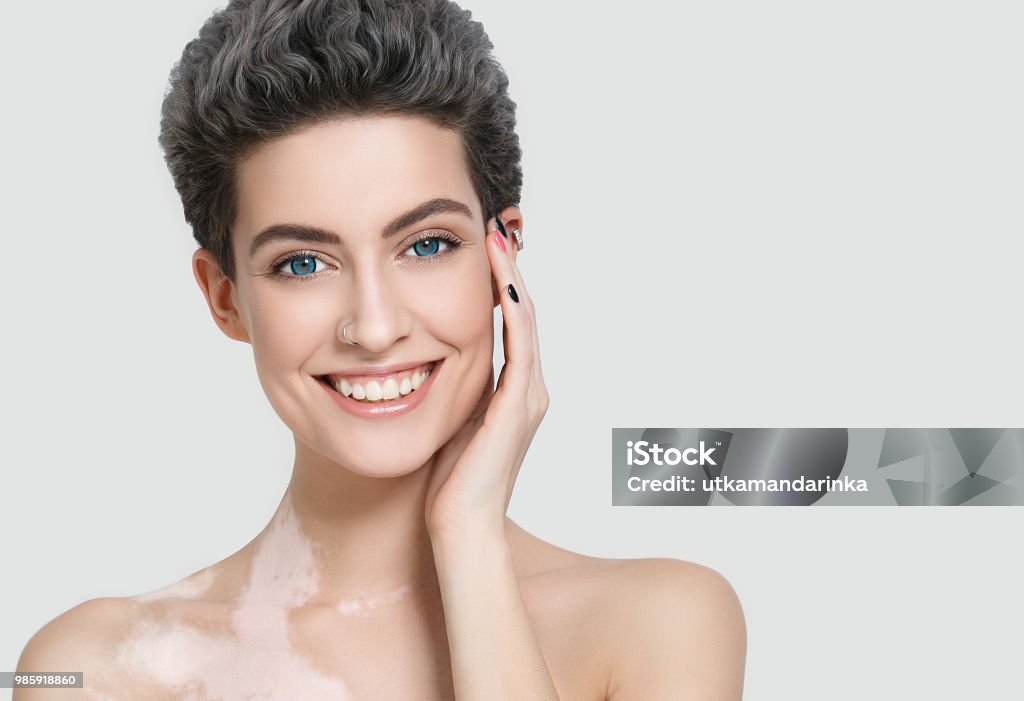 Vitiligo 여자 아름다움 초상화입니다 스튜디오 촬영 회색 배경입니다 백반증에 대한 스톡 사진 및 기타 이미지 백반증