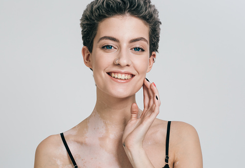 Vitiligo 여자 아름다움 초상화입니다 스튜디오 촬영 회색 배경입니다 건강관리와 의술에 대한 스톡 사진 및 기타 이미지
