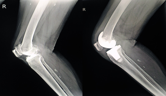 Xray Menunjukkan Lutut Sendi Lutut Ostoearthritis Tampilan Samping Xray ... Xray Menunjukkan Lutut Sendi Lutut Ostoearthritis Tampilan Samping Xray ...