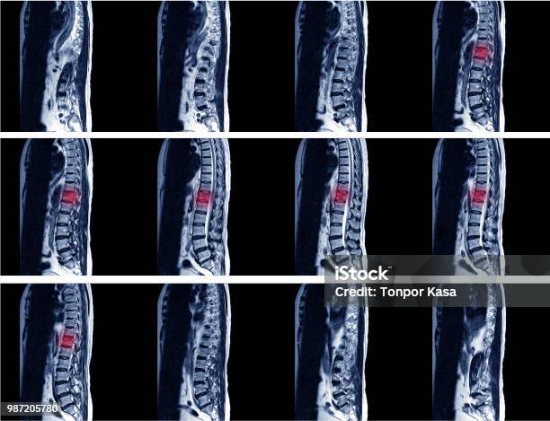 Imagen De Resonancia Magnética De Columna Vertebral Humana Con Lordosis