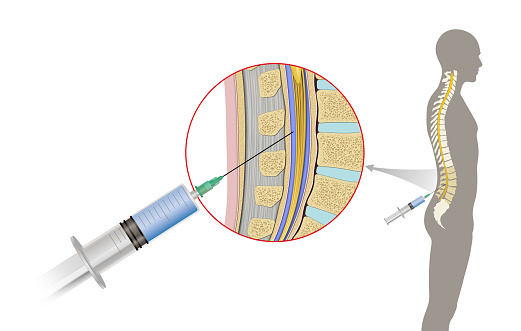 Cerebrospinal Fluid Stock Illustration - Download Image Now - iStock Cerebrospinal Fluid Stock Illustration - Download Image Now - iStock