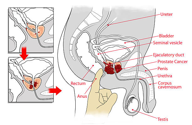 Prostate Exam Illustrations, Royalty-Free Vector Graphics & Clip Art ... Prostate Exam Illustrations, Royalty-Free Vector Graphics & Clip Art ...