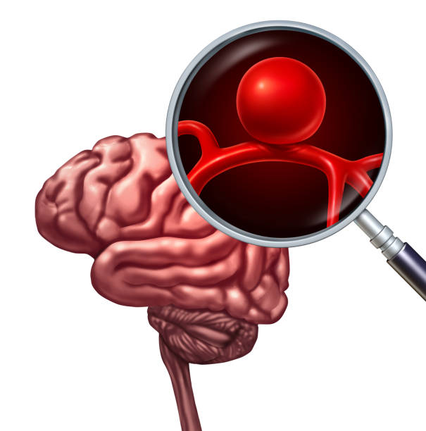Best Aneurysm Stock Photos, Pictures & Royalty-Free Images - iStock Best Aneurysm Stock Photos, Pictures & Royalty-Free Images - iStock