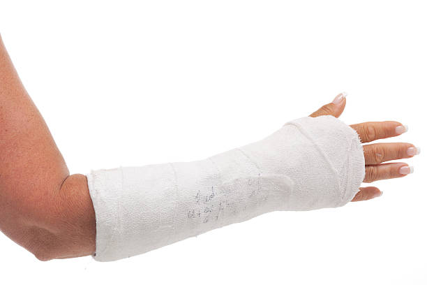 Royalty Free Arm Cast Pictures, Images and Stock Photos - iStock Royalty Free Arm Cast Pictures, Images and Stock Photos - iStock