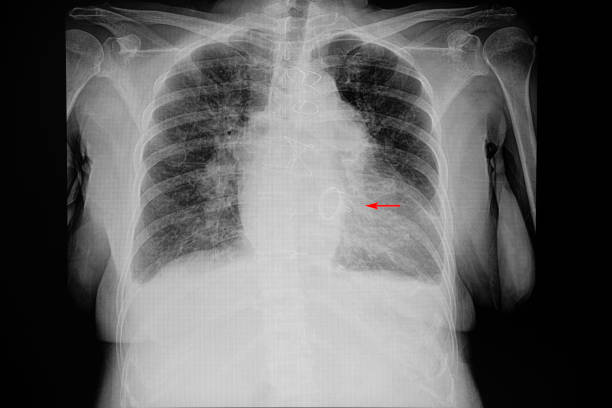 Pulmonary Oedema Chest X Ray Pulmonary Oedema Chest X Ray